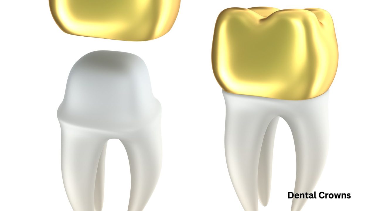 Dental Crowns in Calgary NE - Glad Smiles Dental